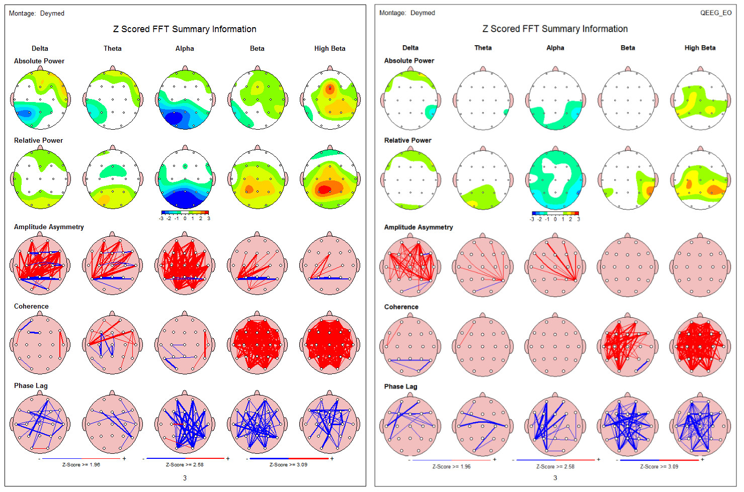 QEEG - Neurofeedback München